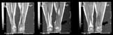 Osteomyelitis