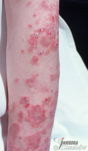 Frühsyphillis Sekundärstadium