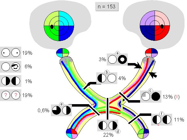 Schematischer Sehbahnfaserverlauf im Bereich des Chiasma opticum